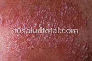 Psoriasis Pustulosa o Pustular: 4 Tipos y Tratamiento