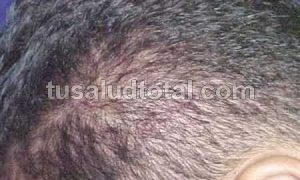 Cómo ELIMINAR las Espinillas Ciegas [3 Remedios CASEROS]