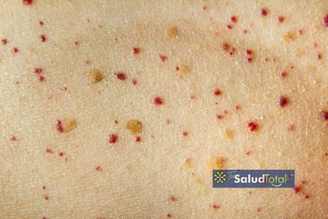 6 Causas de los Lunares Rojos en la Piel: ¿Son Peligrosos?
